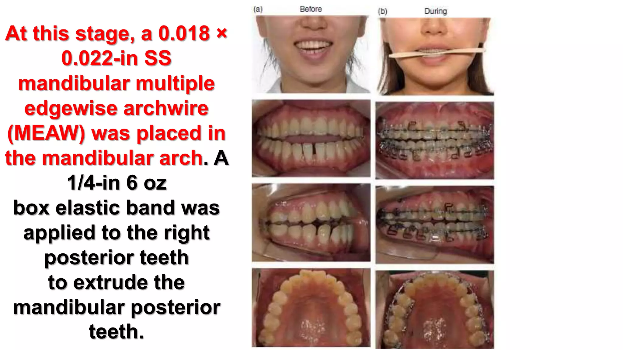 orthodontic correction of canted occlusal plane part 4 | PPTX