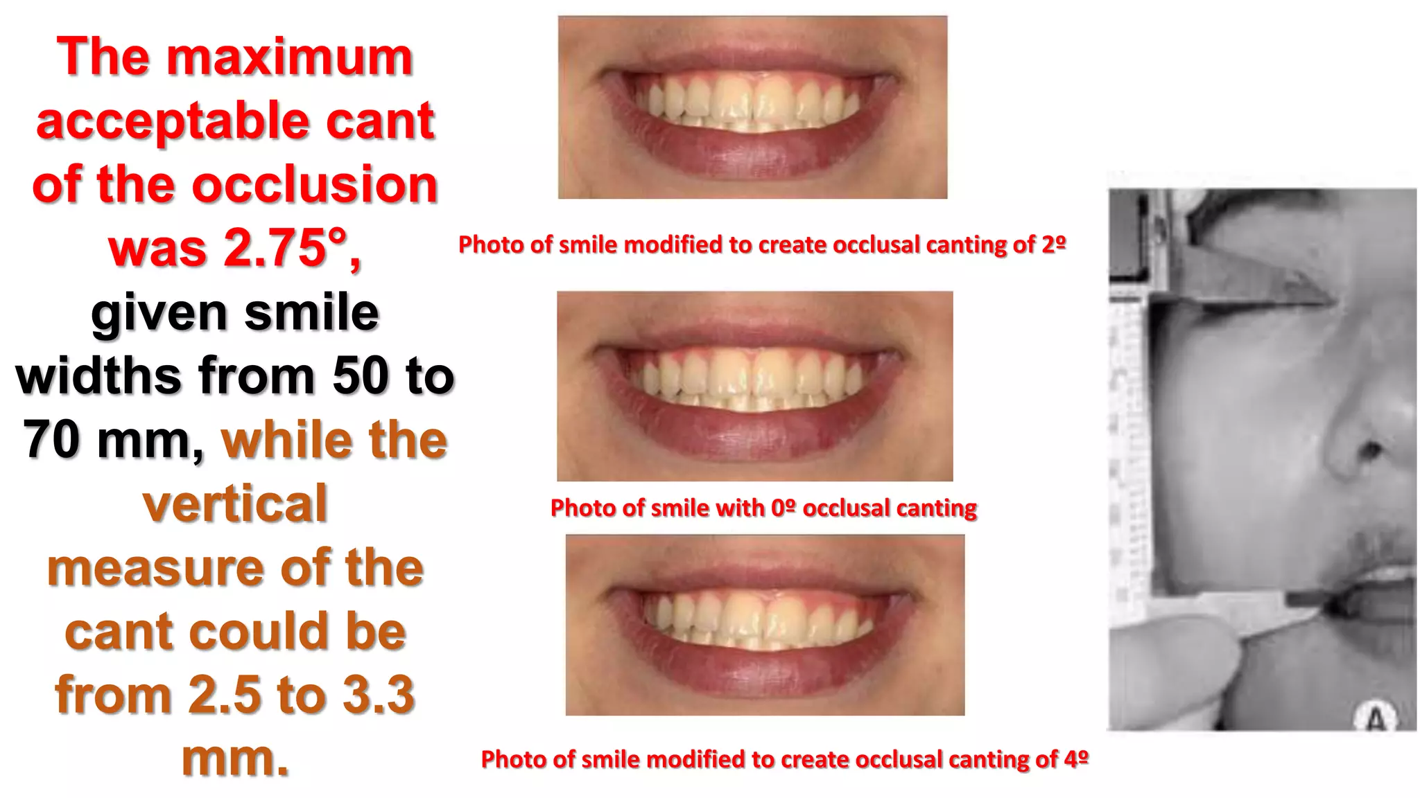 orthodontic correction of canted occlusal plane part 4 | PPTX