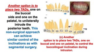 orthodontic correction of canted occlusal plane part 4 | PPTX