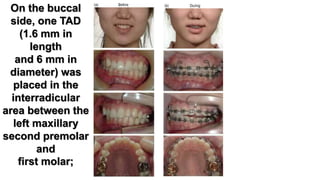 orthodontic correction of canted occlusal plane part 4 | PPTX