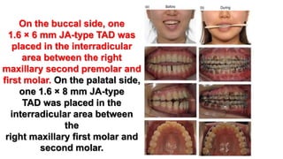 orthodontic correction of canted occlusal plane part 4 | PPTX