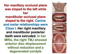 orthodontic correction of canted occlusal plane part 4 | PPTX