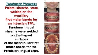 orthodontic correction of canted occlusal plane part 4 | PPTX