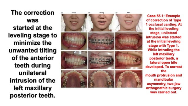 orthodontic correction of canted occlusal plane part 4