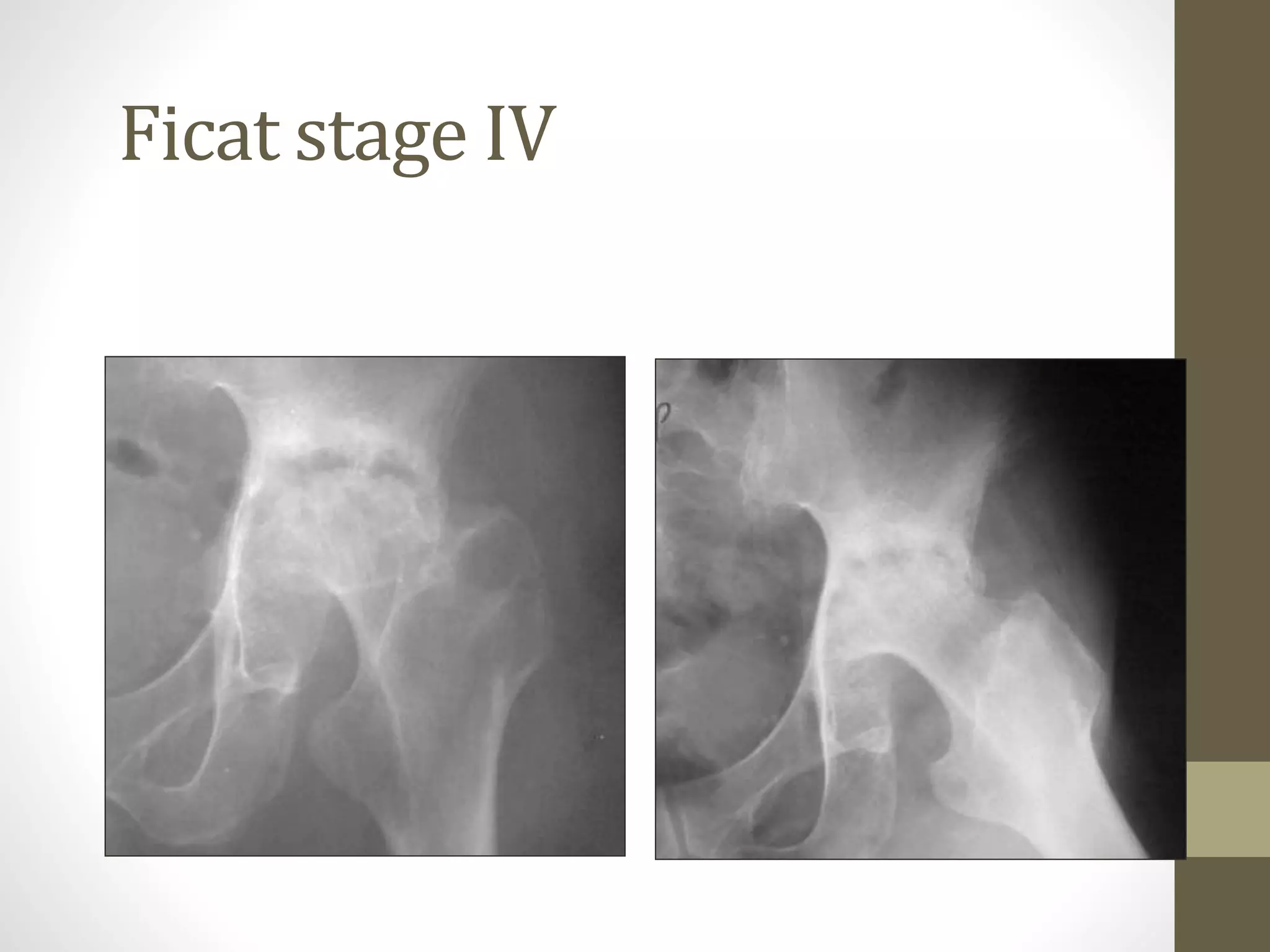Avascular necrosis of femoral head classification | PPTX