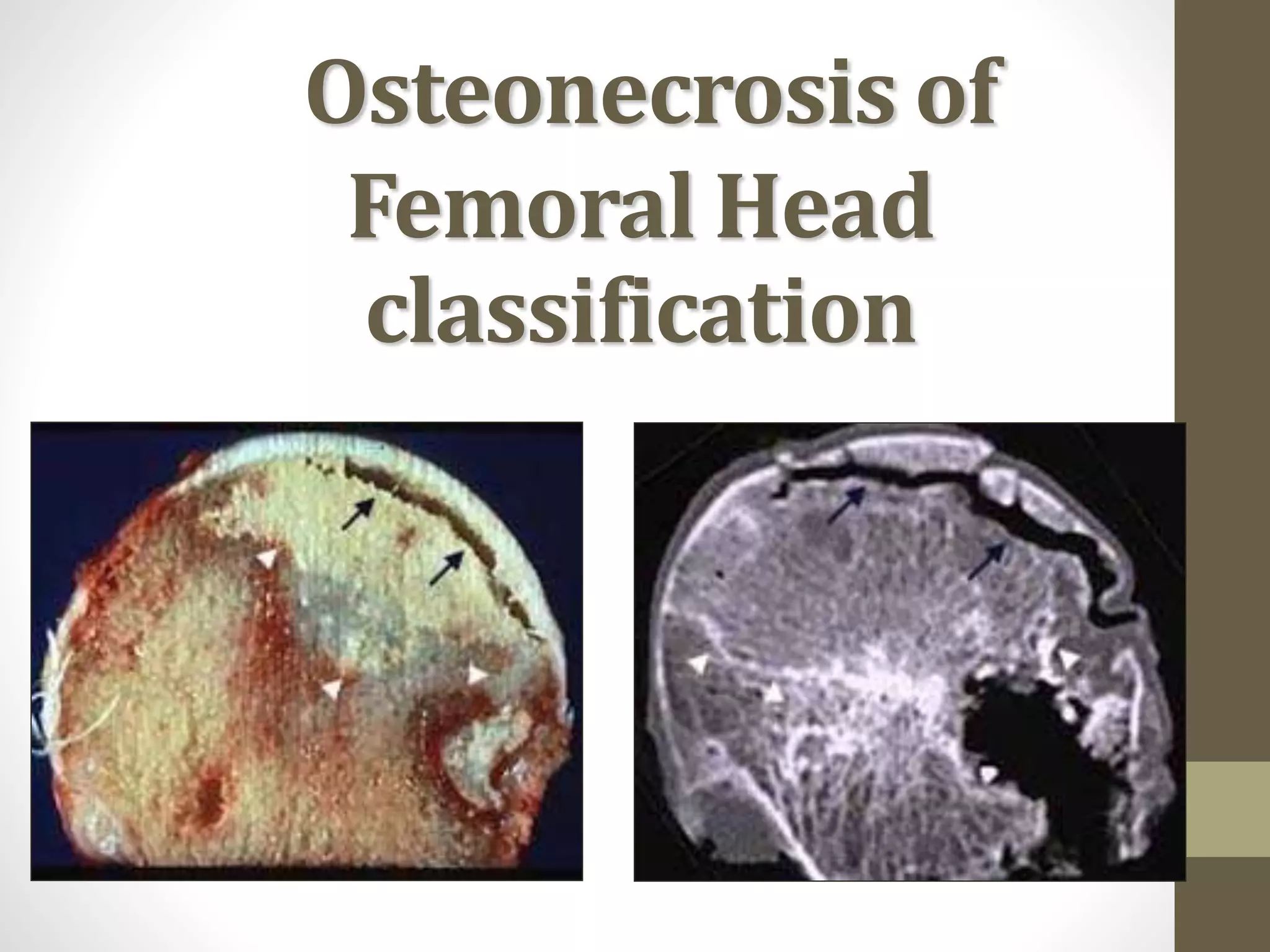 Avascular necrosis of femoral head classification | PPT
