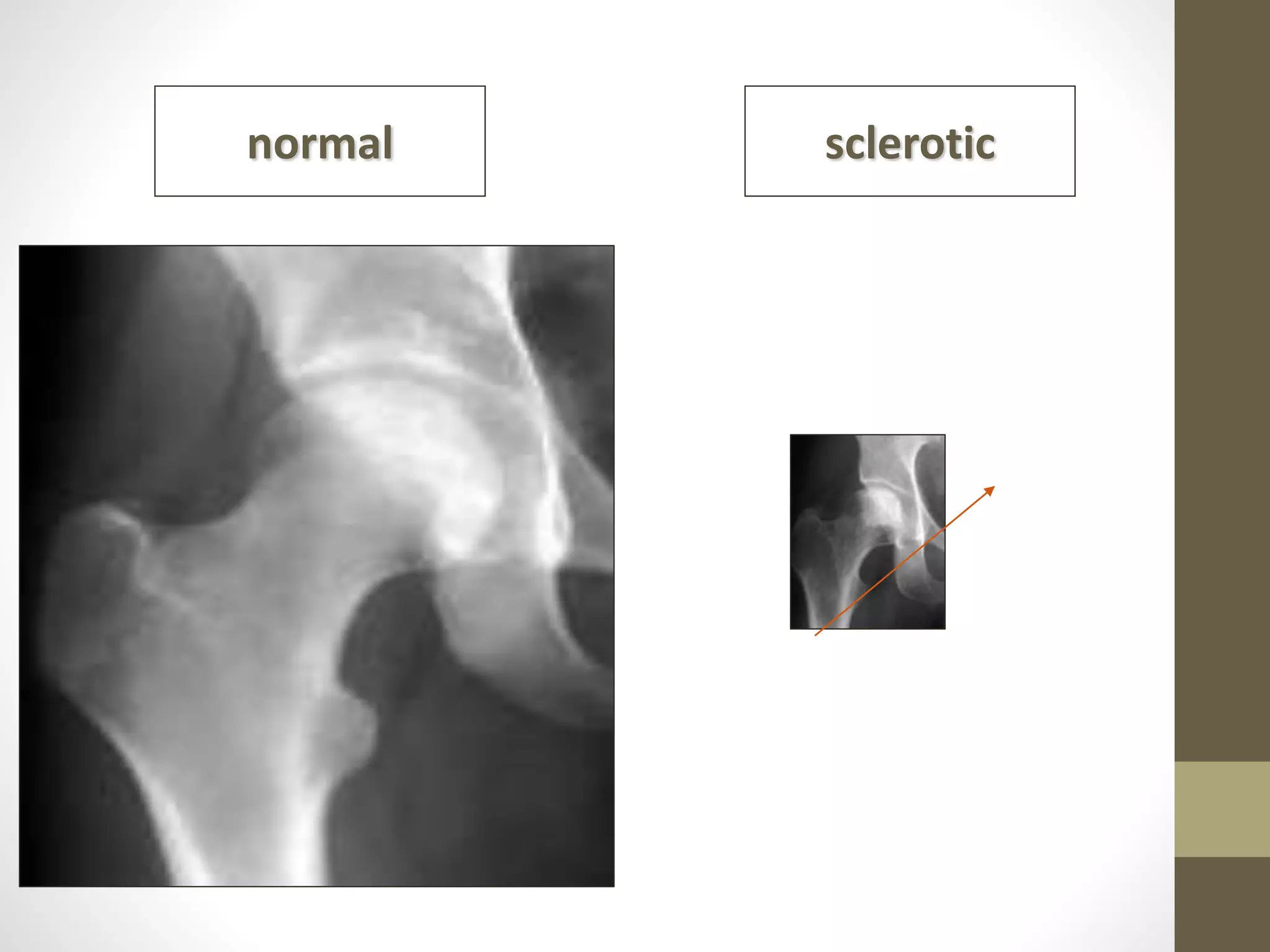 Avascular necrosis of femoral head classification | PPTX