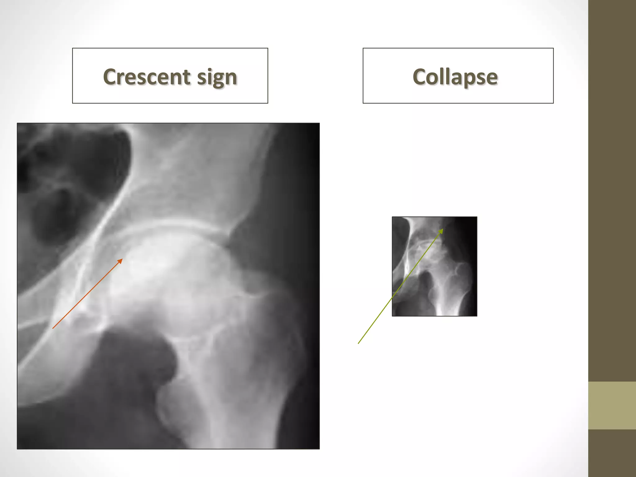 Avascular necrosis of femoral head classification | PPTX