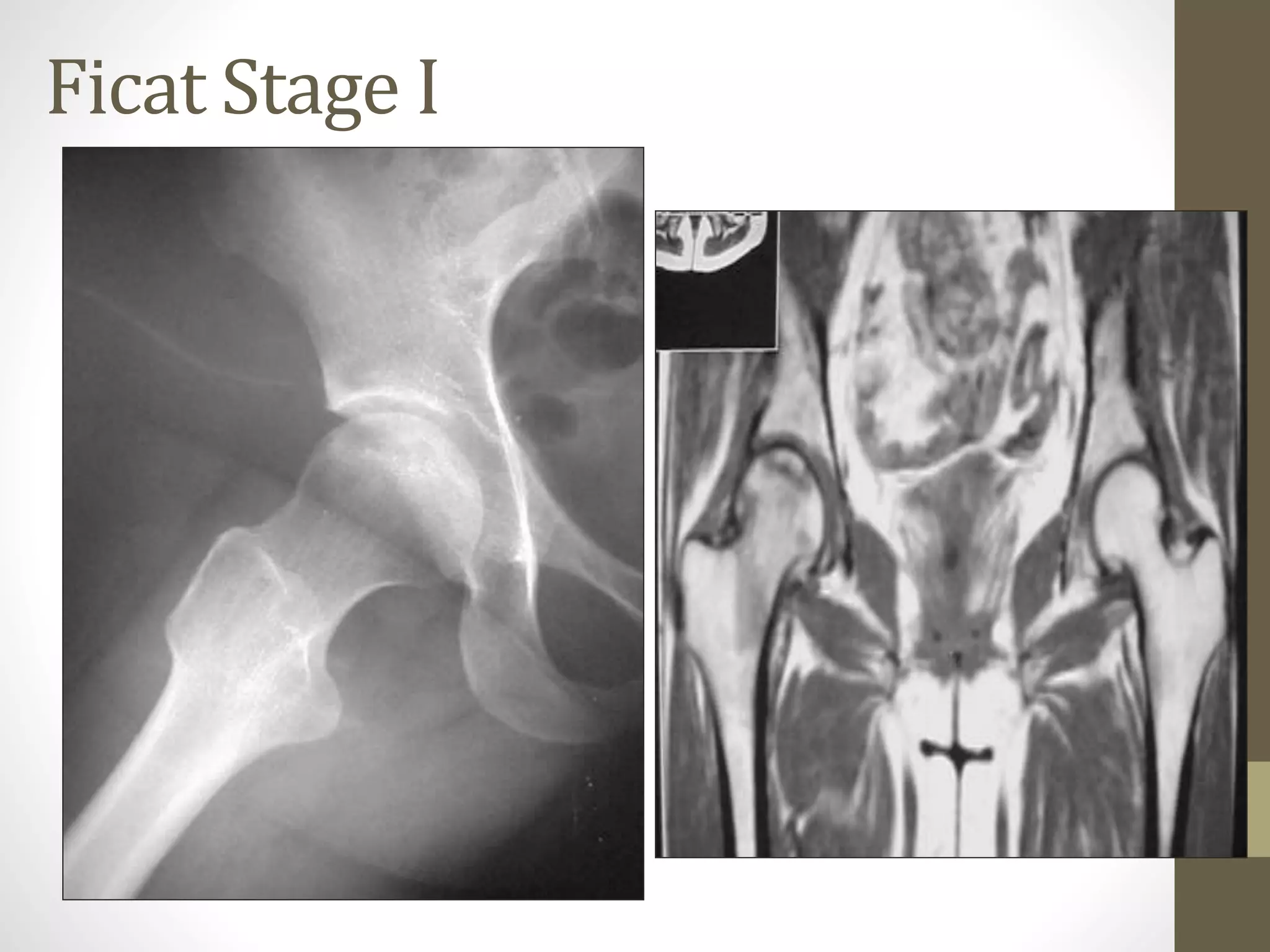 Avascular necrosis of femoral head classification | PPTX