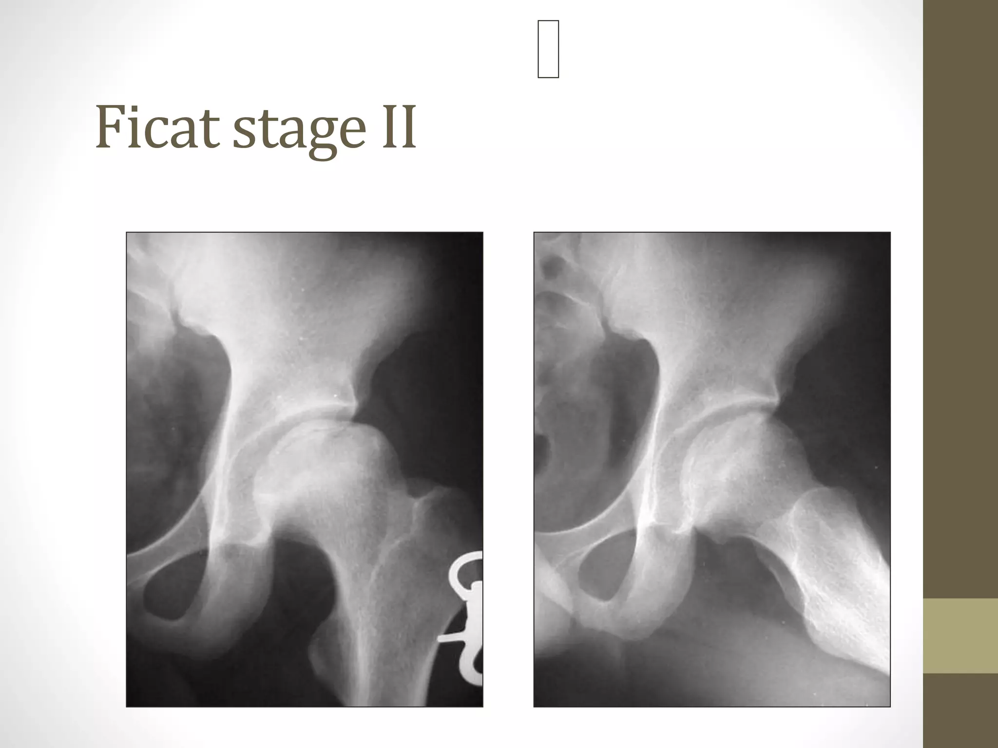 Avascular necrosis of femoral head classification | PPTX