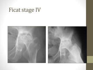 Avascular necrosis of femoral head classification | PPT