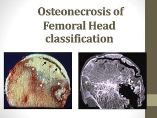 Avascular necrosis of femoral head classification | PPT