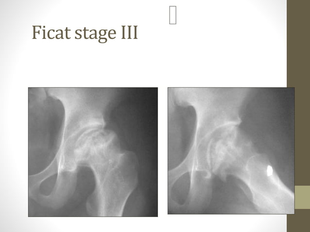 Avascular necrosis of femoral head classification | PPTX