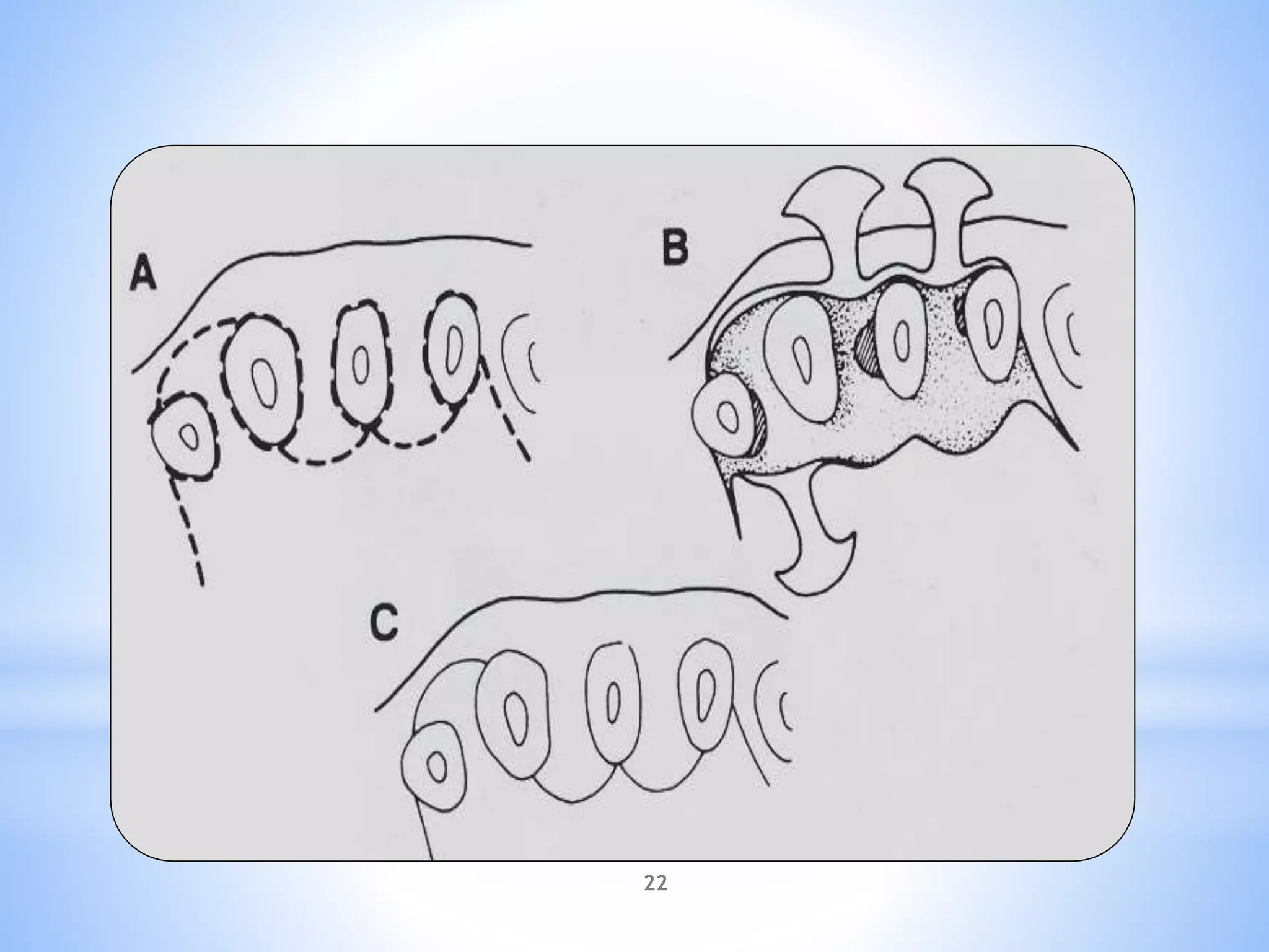 Papilla preservation flap | PPTX