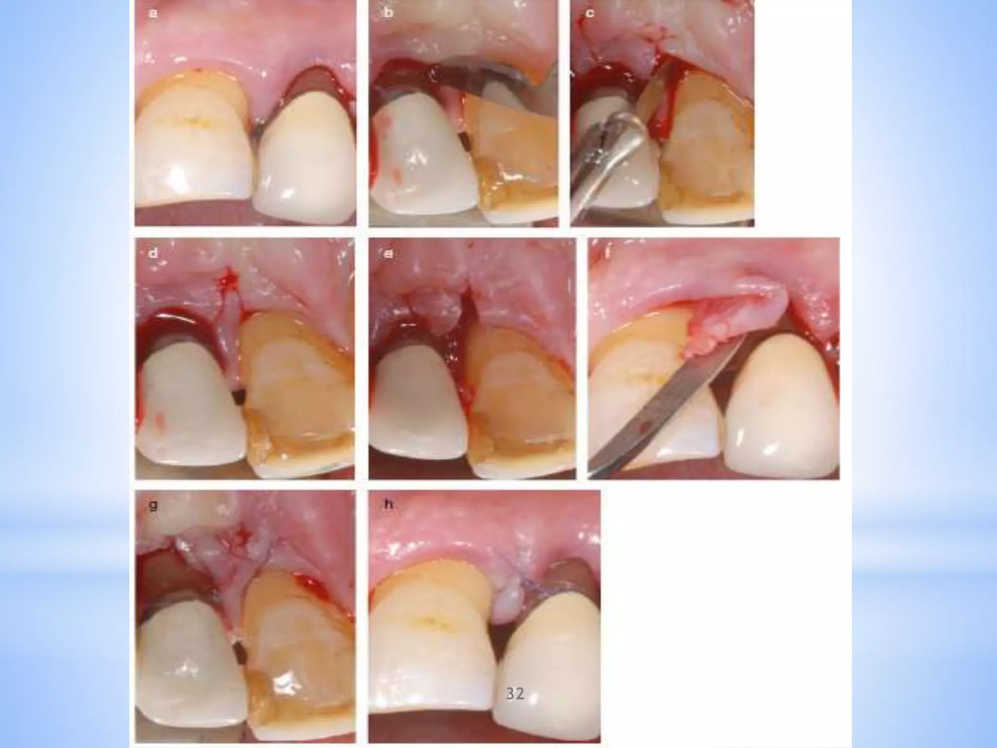 Papilla preservation flap | PPTX