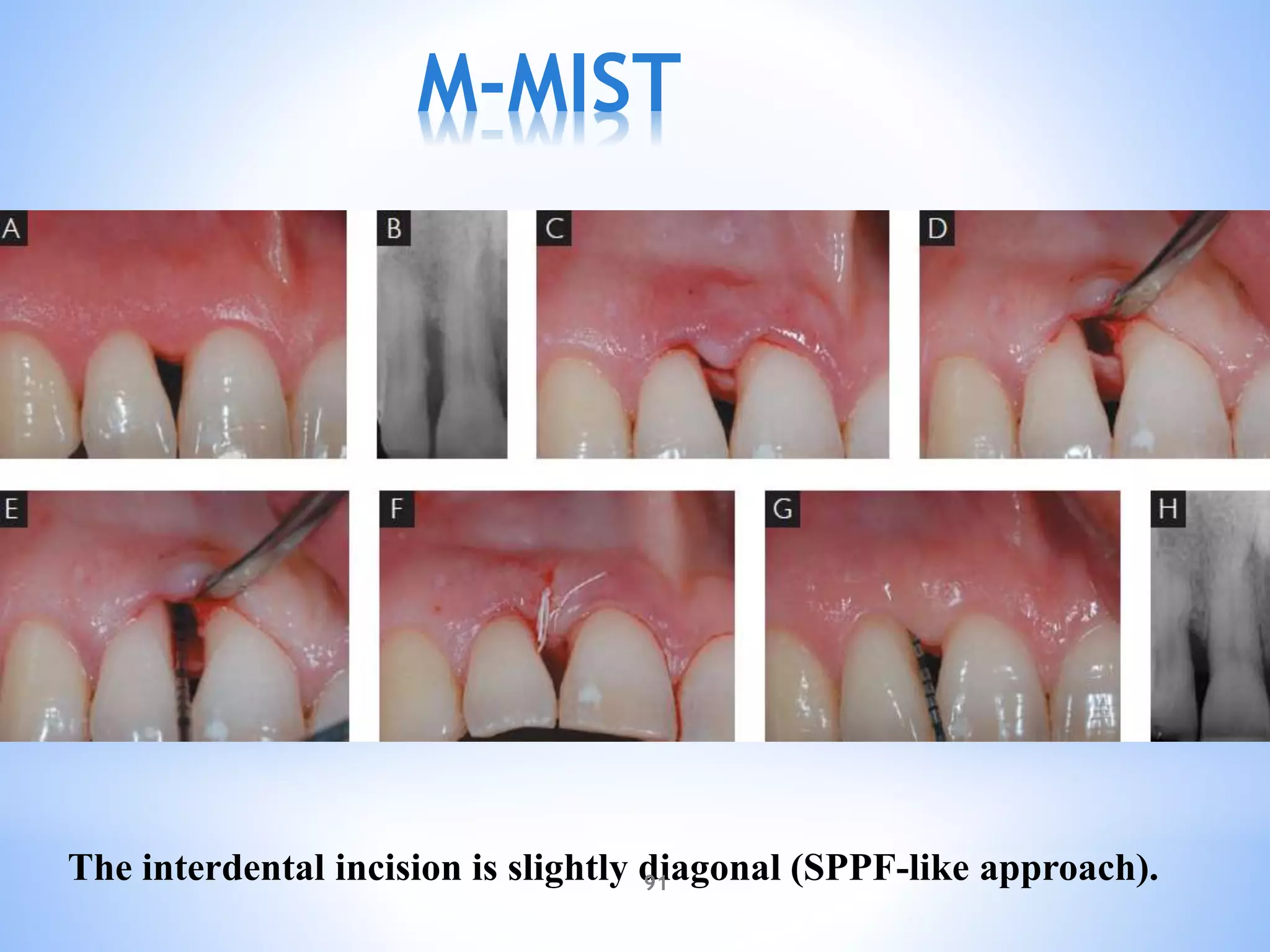 Papilla preservation flap | PPTX