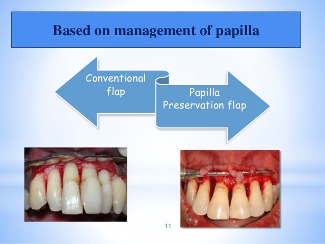Papilla preservation flap