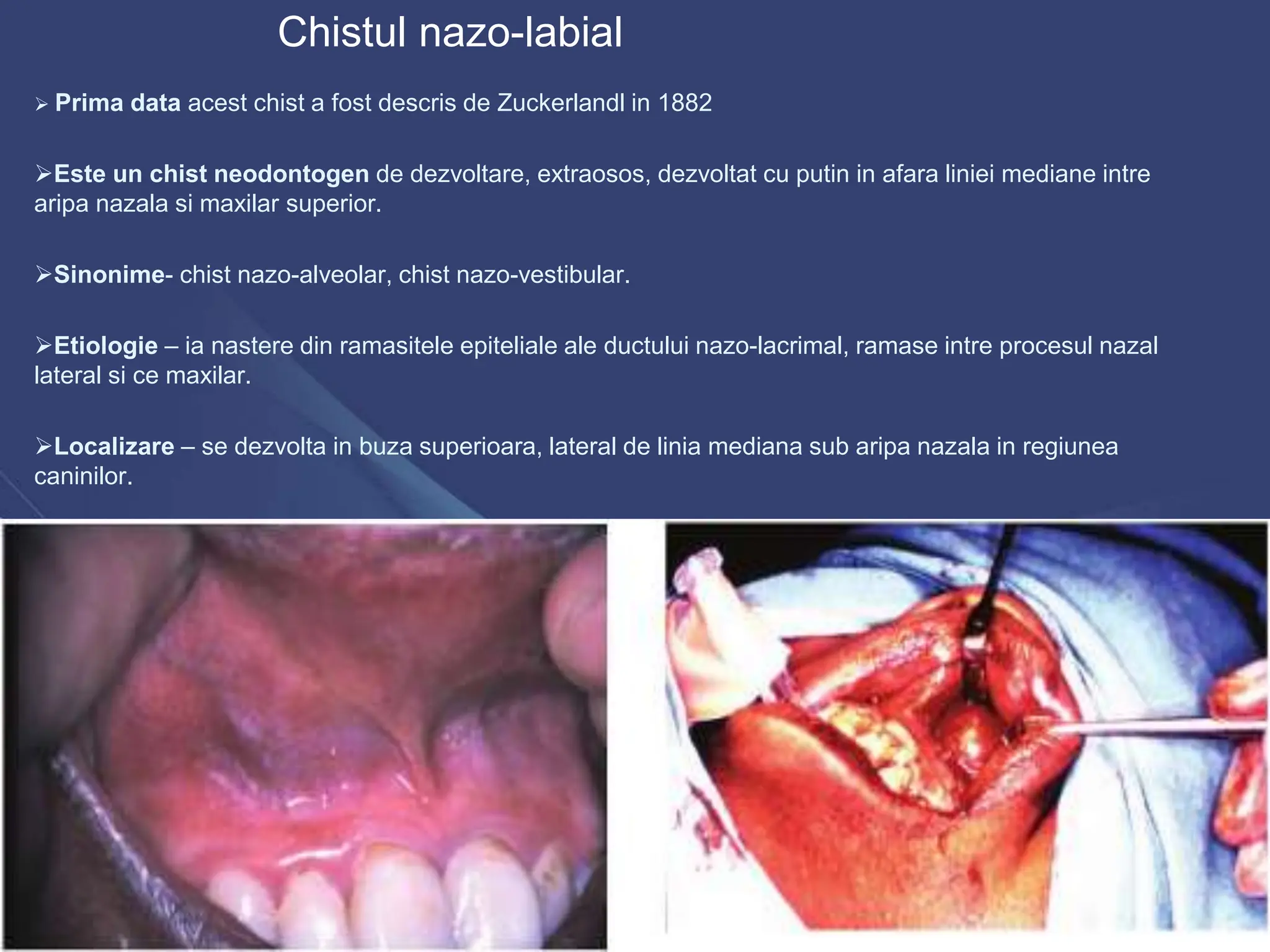 4 Prelegere Chisturile Neodontogene si Pseudochisturile de maxilar.ppt