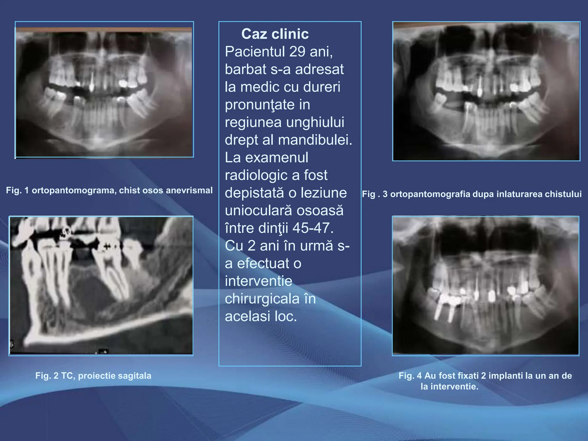 4 Prelegere Chisturile Neodontogene si Pseudochisturile de maxilar.ppt