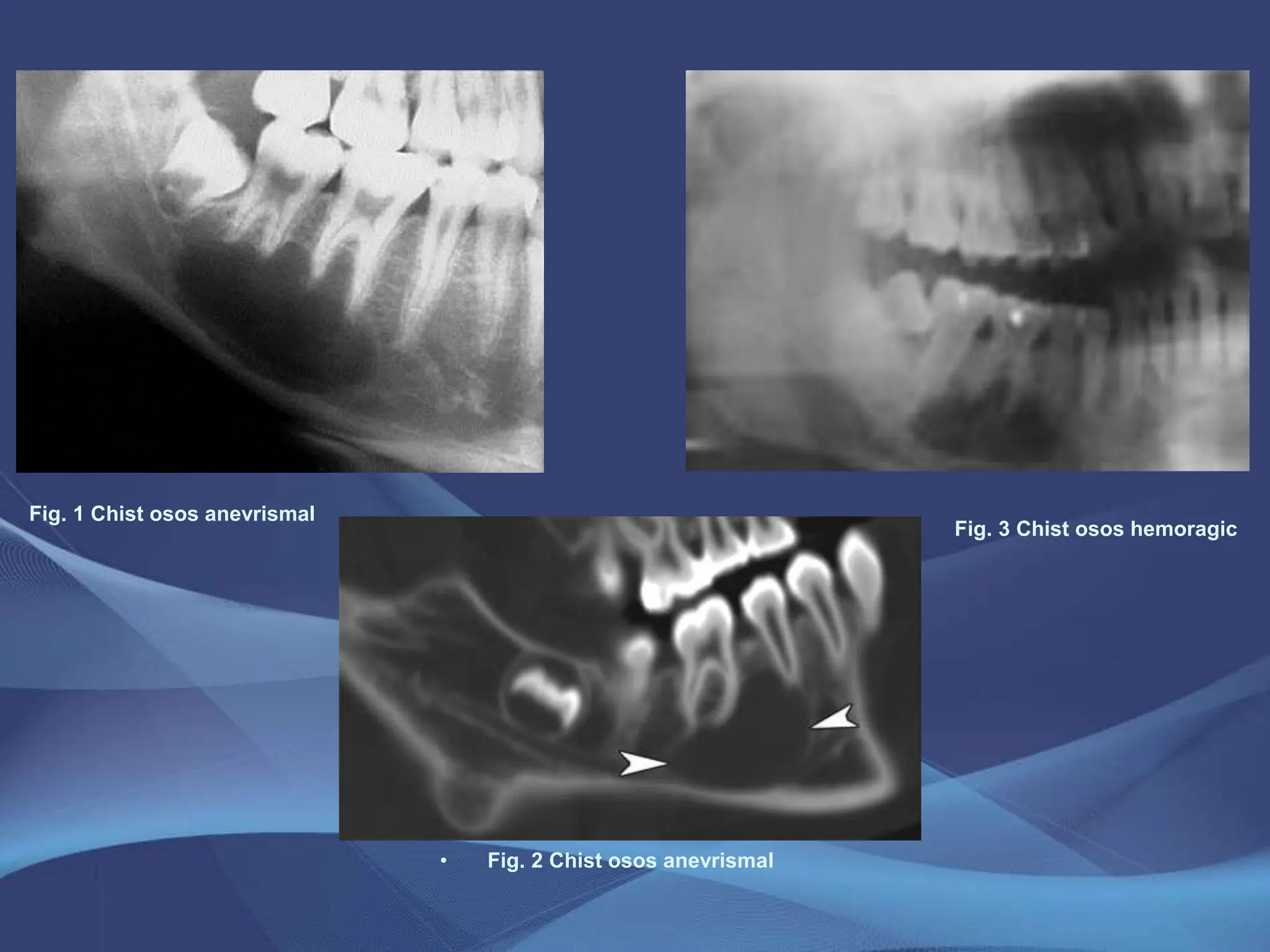 4 Prelegere Chisturile Neodontogene si Pseudochisturile de maxilar.ppt