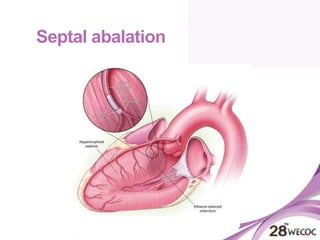 4Raharjo SB - Alcohol Septal Ablation.pptx