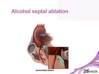 4Raharjo SB - Alcohol Septal Ablation.pptx