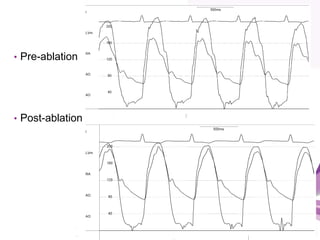 4Raharjo SB - Alcohol Septal Ablation.pptx