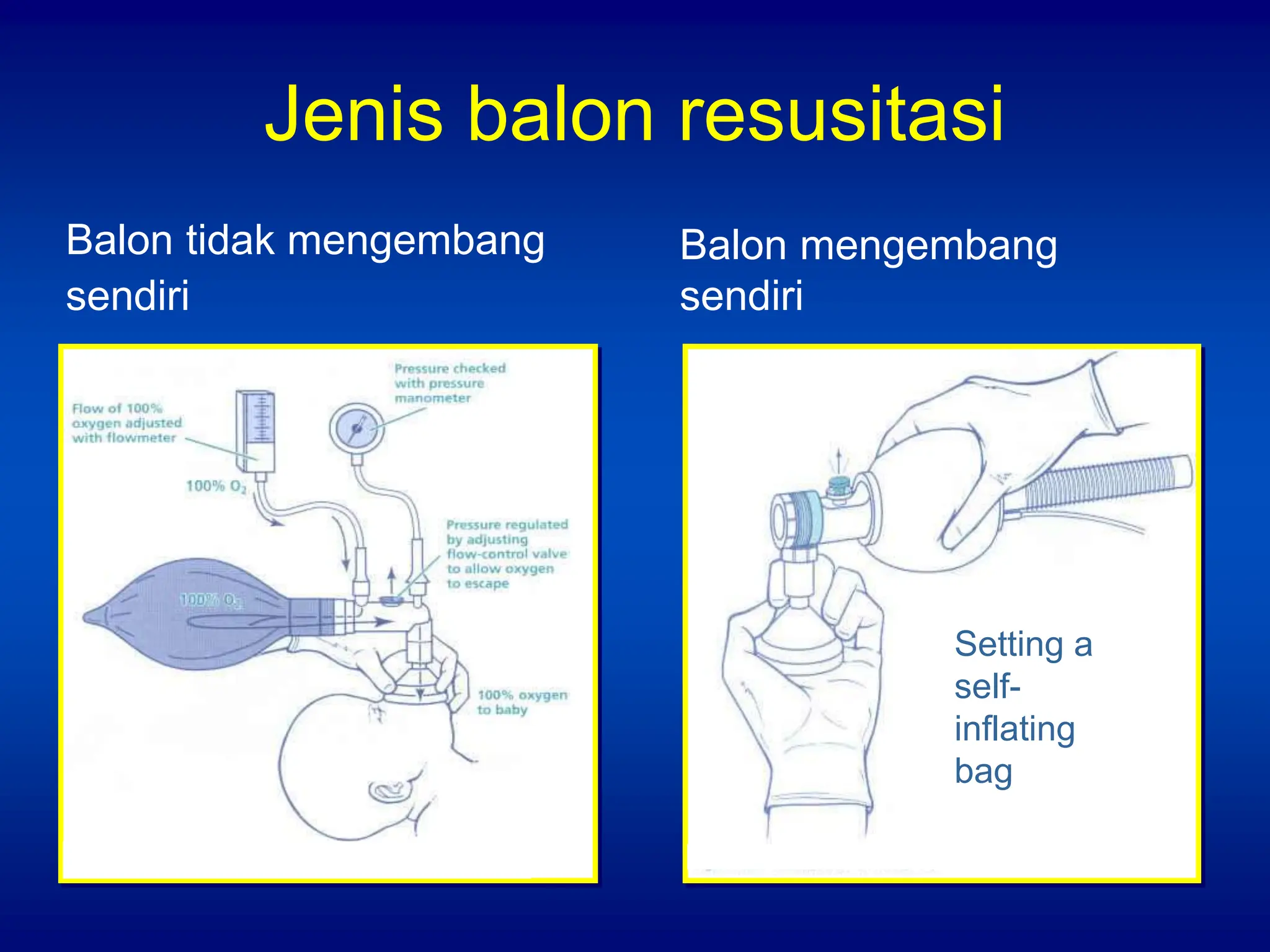 Resusitasi neonatus update | PPT