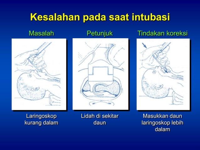 Resusitasi neonatus update | PPT