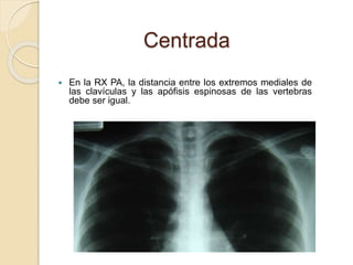 Rayos X de Torax P.A. | PPTX