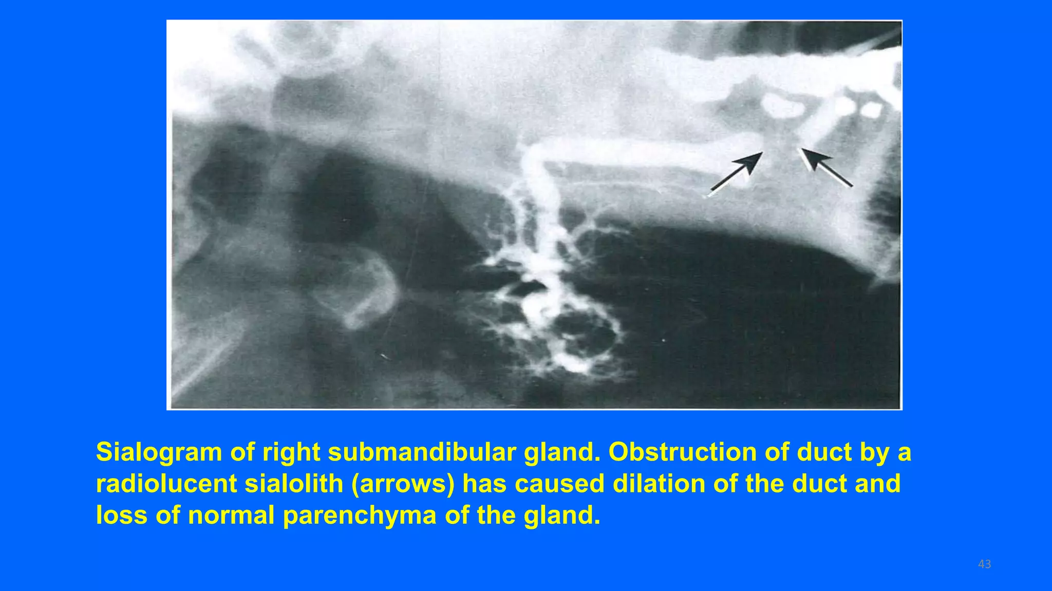 lecture 4 Diagnosis and management of salivary gland disorders | PPTX