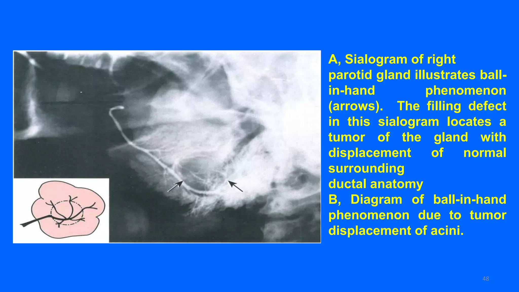 lecture 4 Diagnosis and management of salivary gland disorders | PPTX