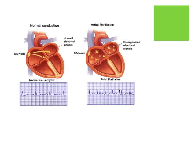 Screening For Cardiovascular Disease | PPT