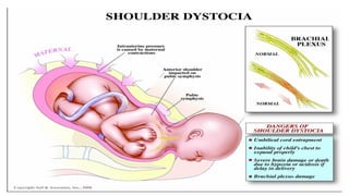 shoulder dystocia in obstetrics edit.pptx