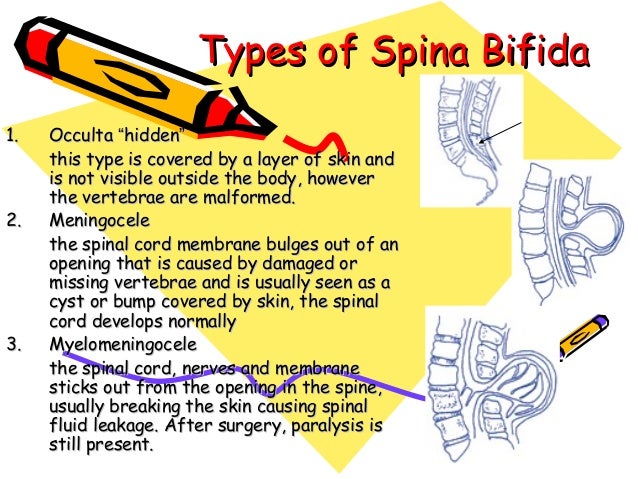 4 Signs Symptoms And Causes Of Spina Bifida