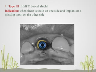 4) Socket shield technique prosthodontics | PPTX