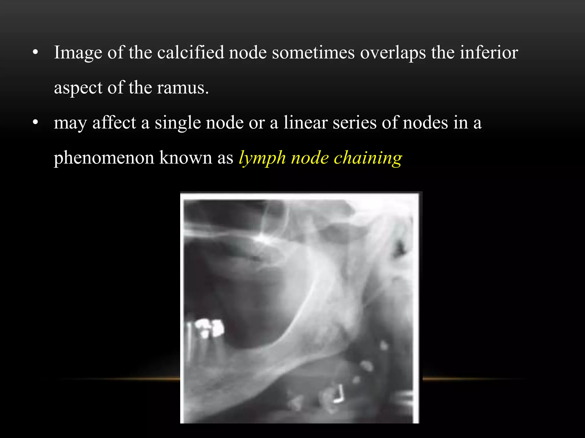 Soft tissue calcifications of the oral cavity | PPTX