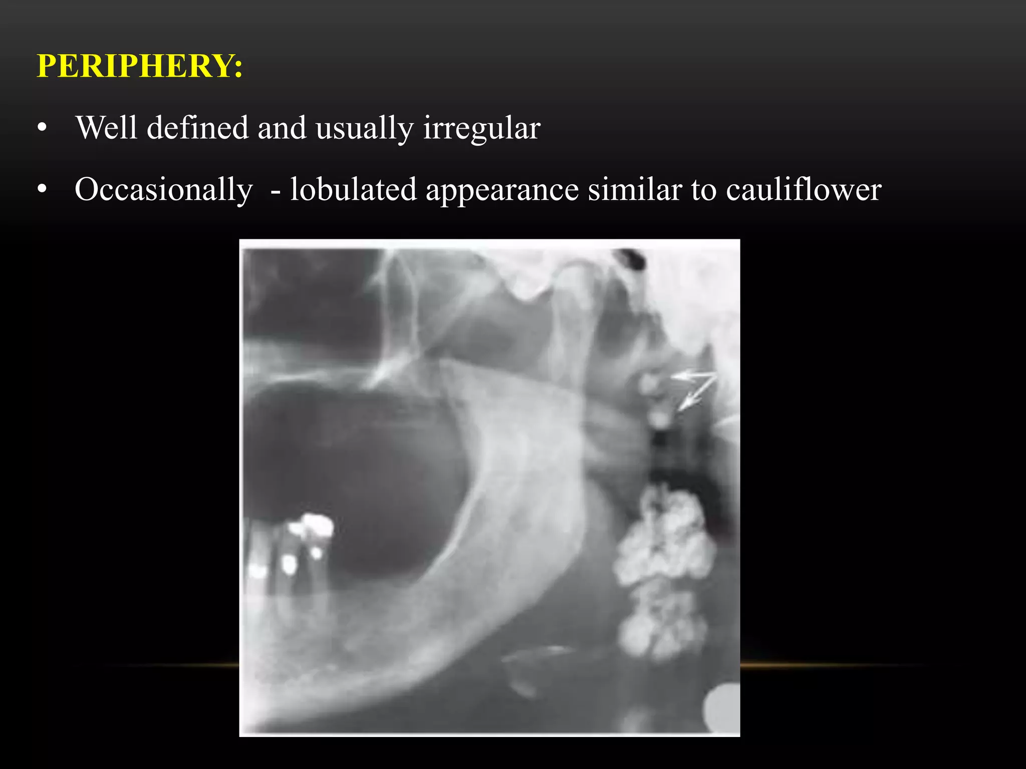 Soft tissue calcifications of the oral cavity | PPTX