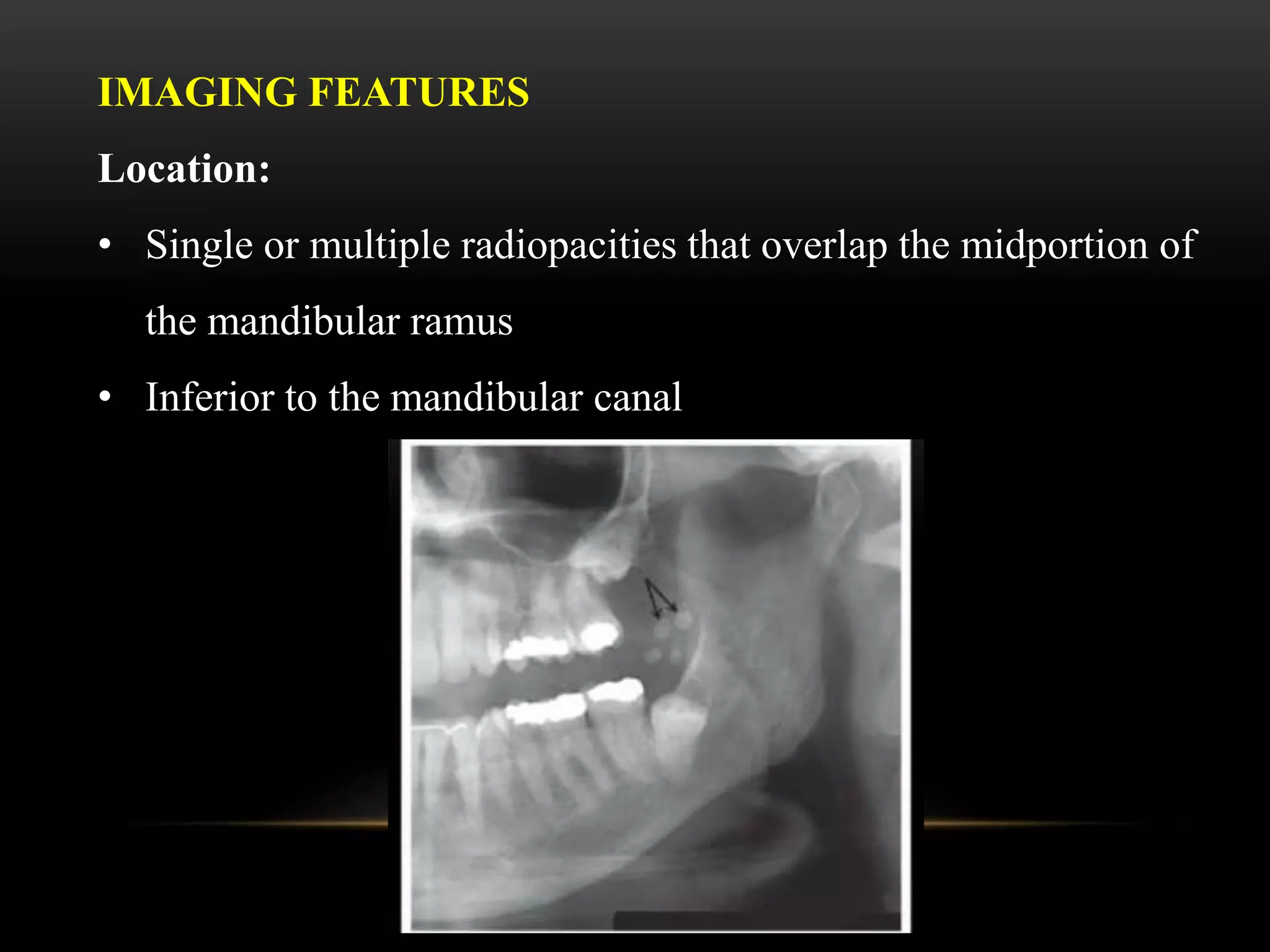 Soft tissue calcifications of the oral cavity | PPTX