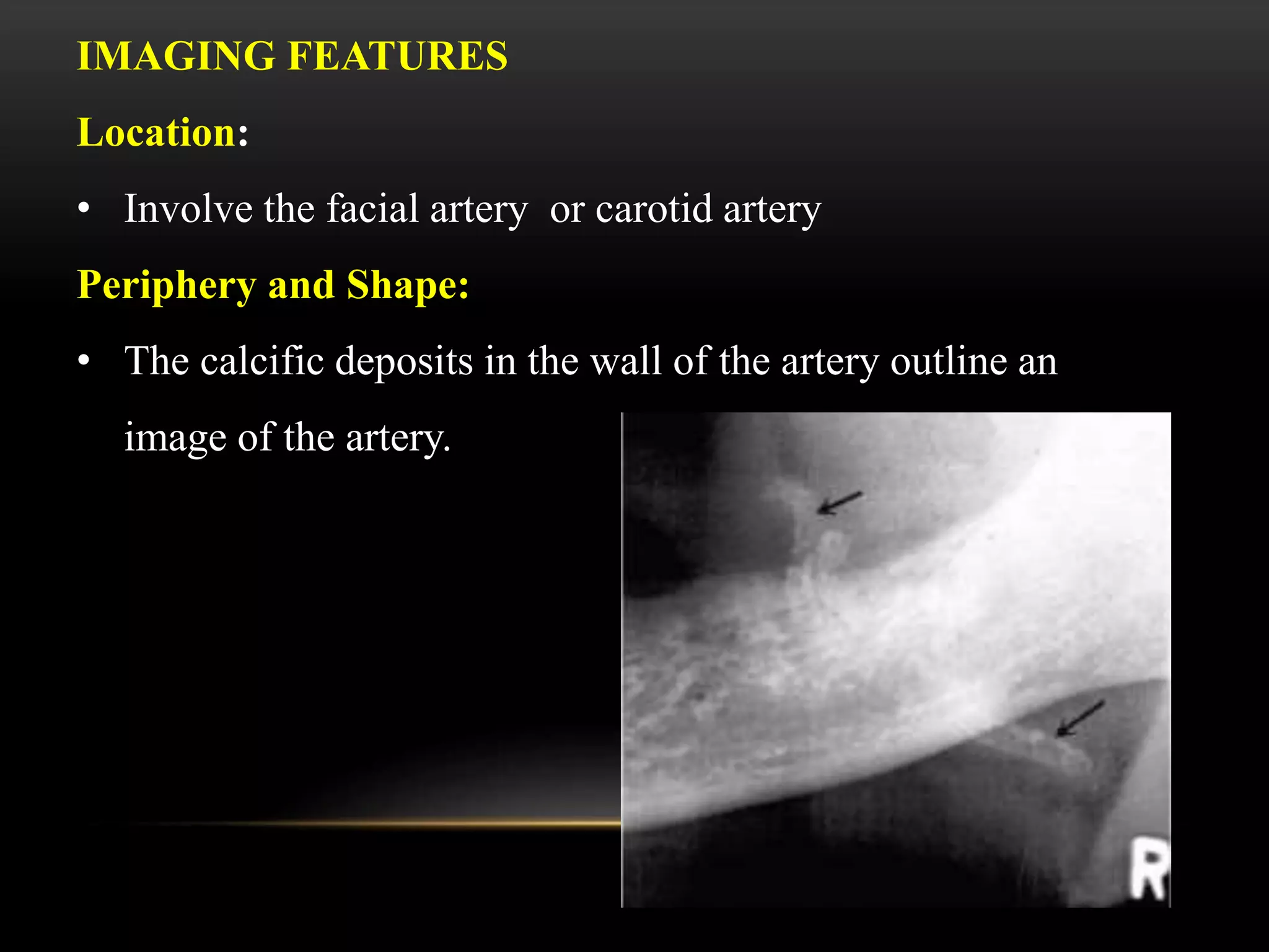 Soft tissue calcifications of the oral cavity | PPTX