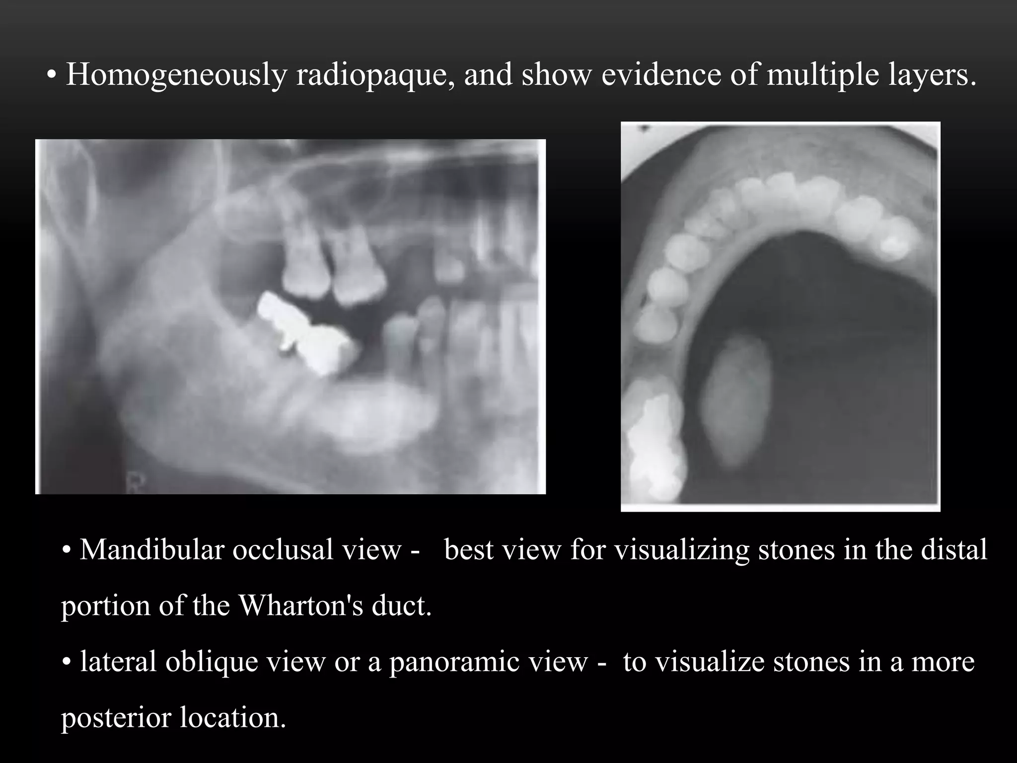 Soft tissue calcifications of the oral cavity | PPTX