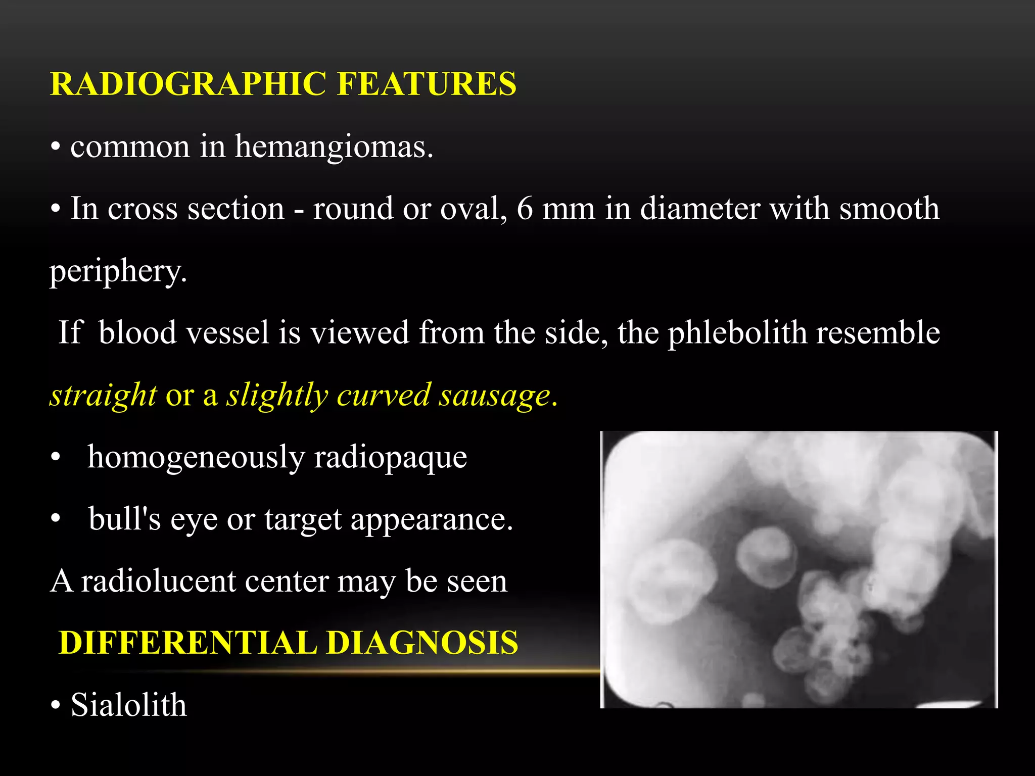 Soft tissue calcifications of the oral cavity | PPTX