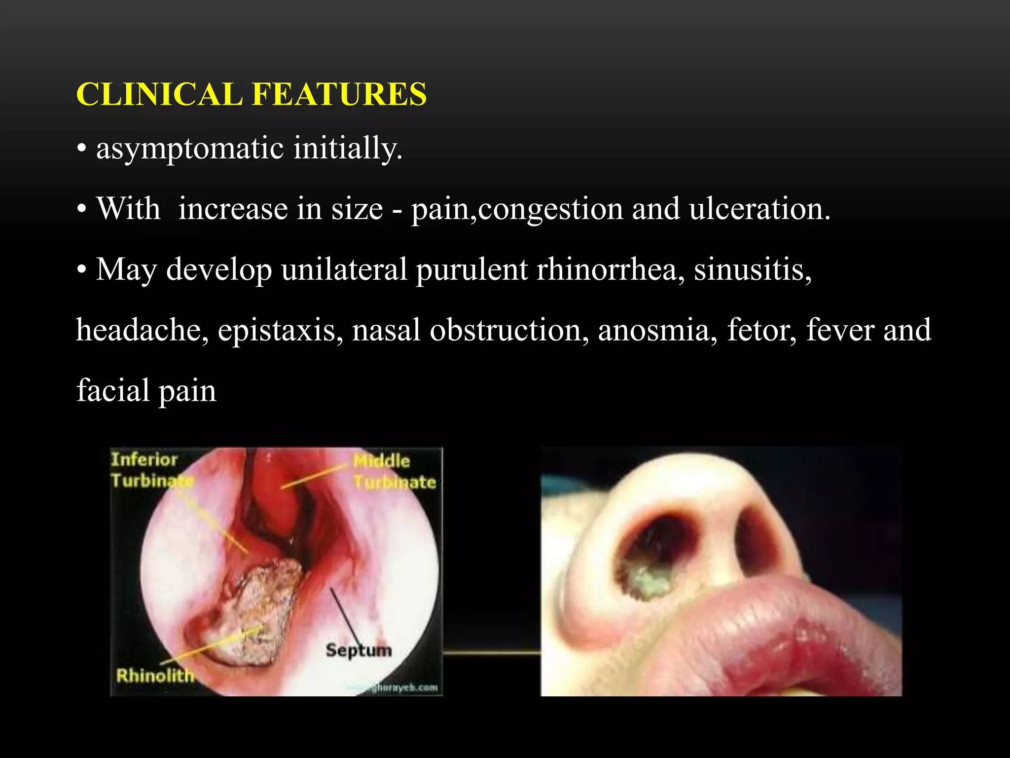 Soft tissue calcifications of the oral cavity | PPTX