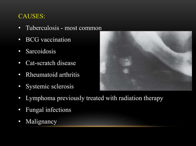 Soft tissue calcifications of the oral cavity | PPTX