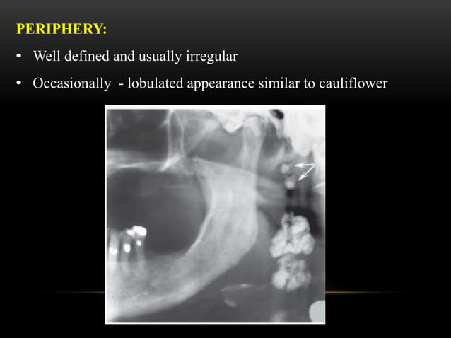 Soft tissue calcifications of the oral cavity | PPTX