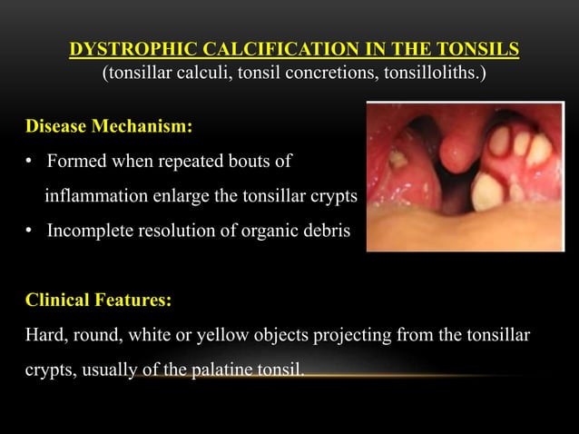 Soft tissue calcifications of the oral cavity | PPTX