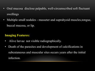 Soft tissue calcifications of the oral cavity | PPTX