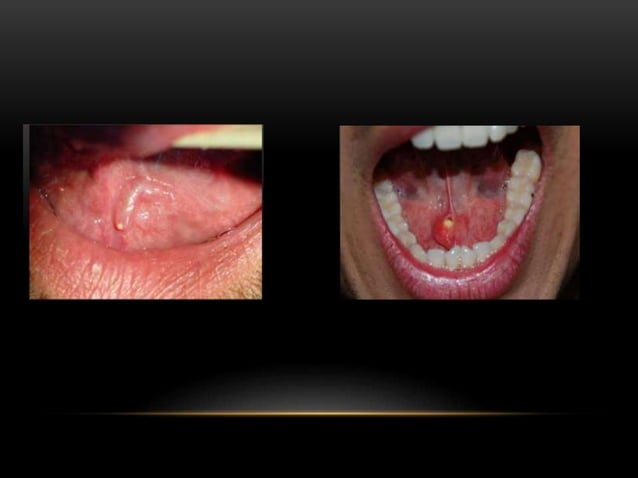 Soft tissue calcifications of the oral cavity | PPTX