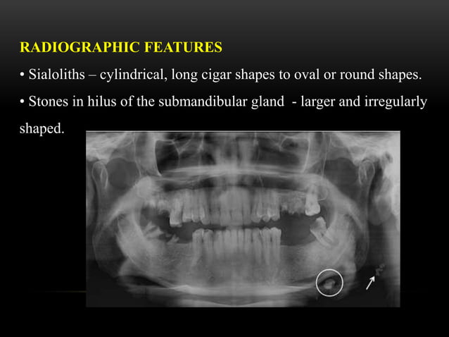 Soft tissue calcifications of the oral cavity | PPTX