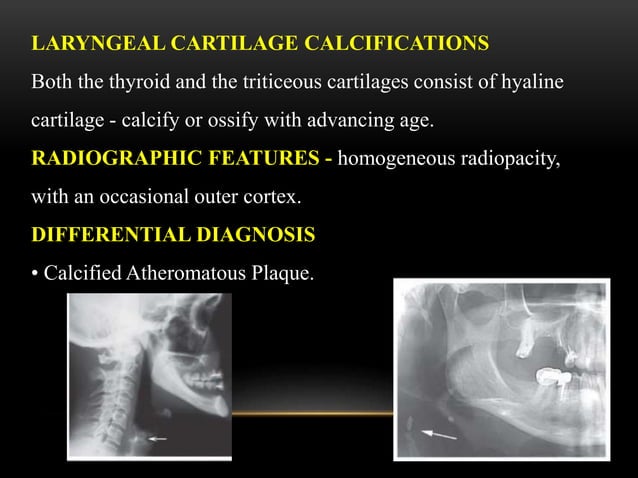 Soft tissue calcifications of the oral cavity | PPTX